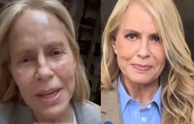Desfigurada: así quedó Cecilia Bolocco después de un tratamiento facial