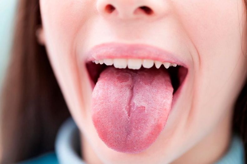 Revelado por Harvard: el color de tu lengua puede mostrar si tenés ...