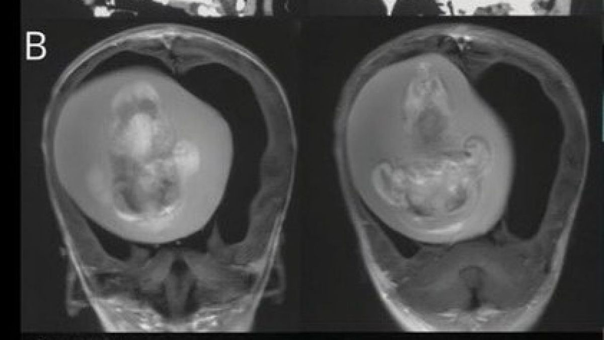 Extraño caso: extraen un feto vivo de la cabeza a una nena de un año