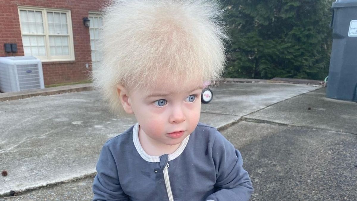 Un nene padece Síndrome de Cabello Impeinable y conmueve a las redes ...